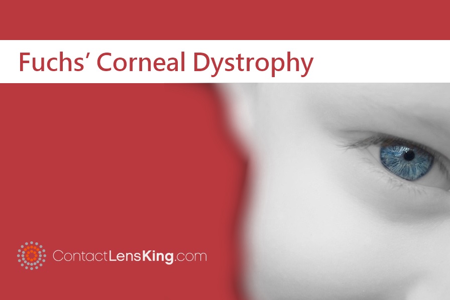 Fuchs’ corneal dystrophy | Fuchs’ Endothelial Dystrophy - Contact Lens ...