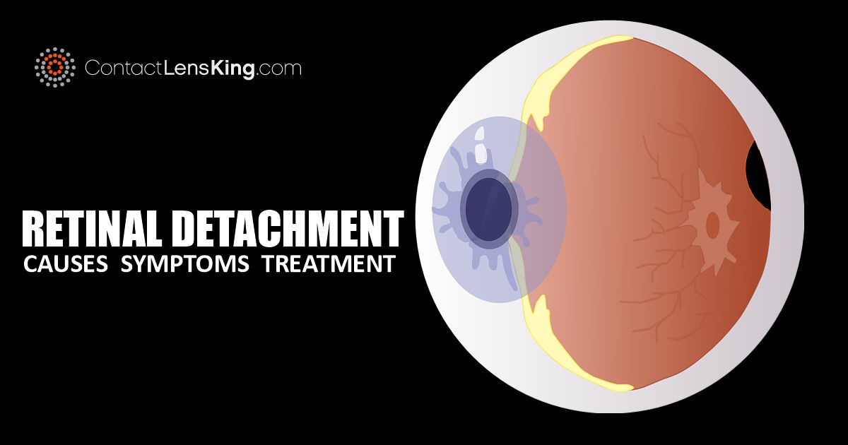 Retinal Detachment Causes, Symptoms and Treatment - Contact Lens King Blog
