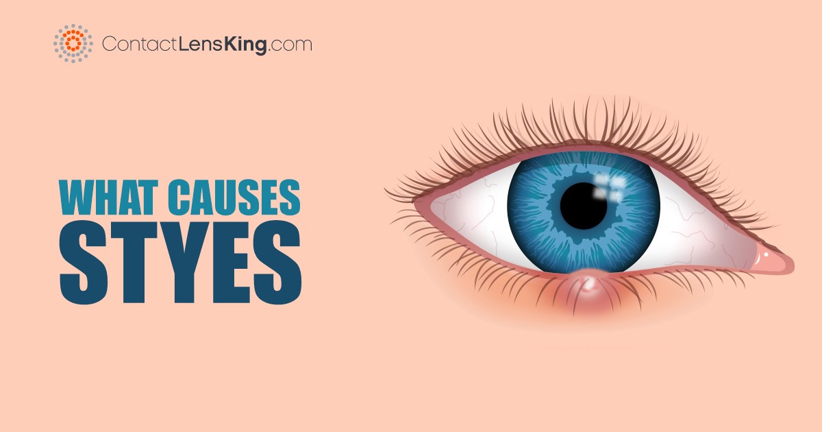 What Causes Styes? Eye Stye Treatment and Symptoms - Contact Lens King Blog