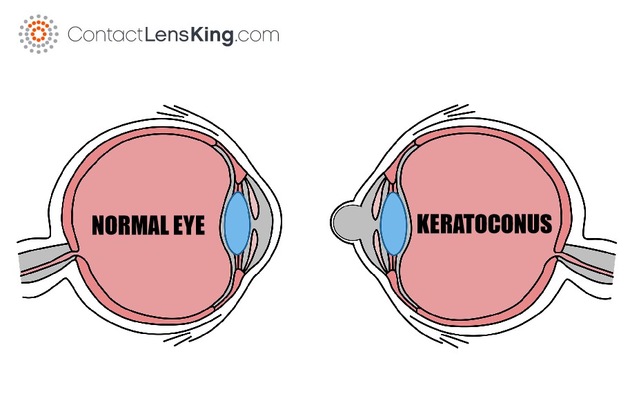 Keratoconus Causes, Treatments and Symptoms - Contact Lens King Blog
